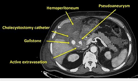 Axial Ct Angiography Reconstruction Indicates Active Extravasation From Download Scientific
