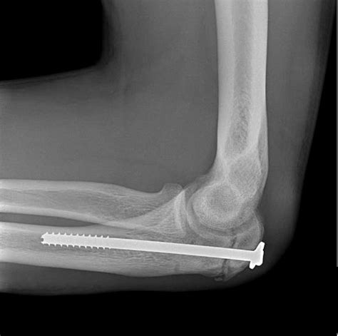 Olecranon Fracture