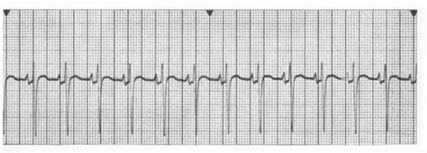 Types Of Tachycardia EKGS Flashcards Quizlet