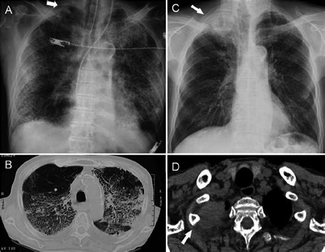 A X Ray Showing Bilateral Diffuse Reticular Shadows With A Nodular Download Scientific Diagram