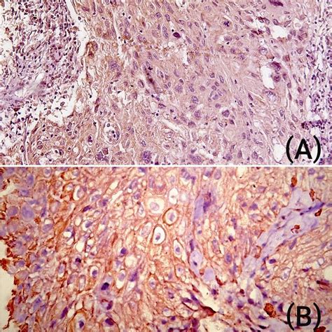 Photomicrograph Showing Positive Cytoplasmic Expression Of Anti Hpv16 A