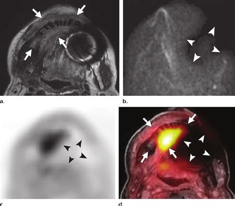 Dental Hardware Artifact Leading To Tumor Underestimation At Follow Up Download Scientific