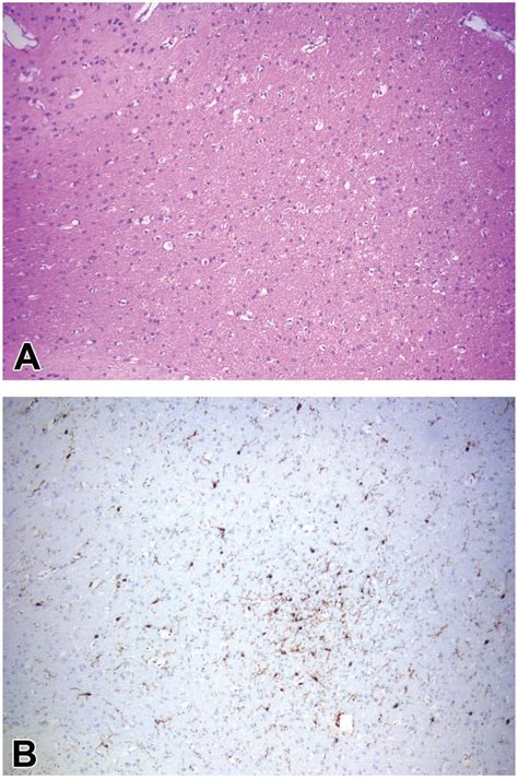 Incidental Gliosis In The Central Nervous System Of Control Nonhuman