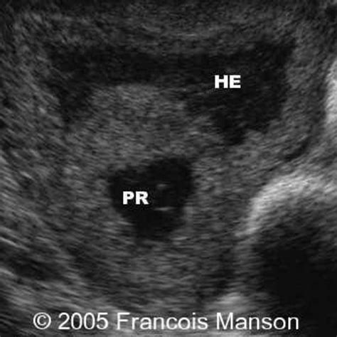 📃 Ectopic Pregnancy Cornual
