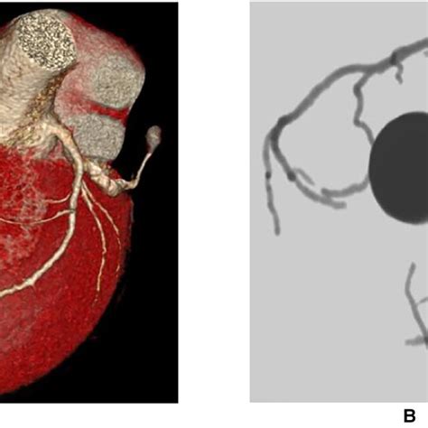 Computed Tomography Coronary Angiogram A Course Of The LCx On The Download Scientific