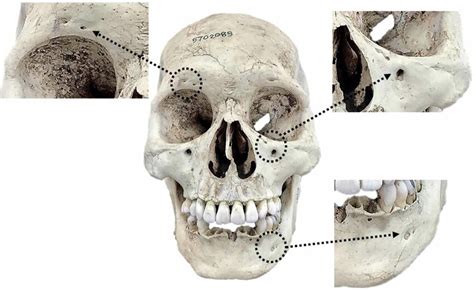 Supraorbital Foramen