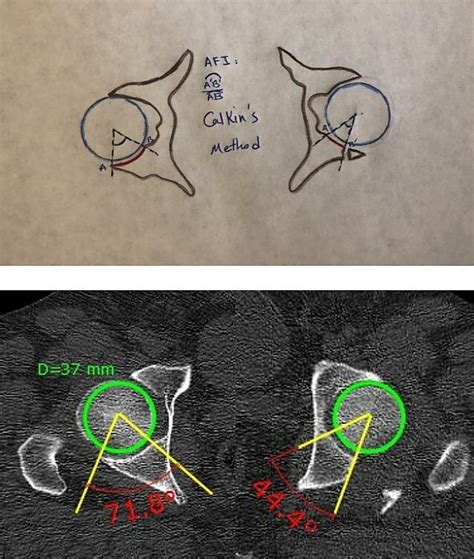 Measuring Acetabular Fracture Index Afi In Calkins Et Al Method 11 Download Scientific