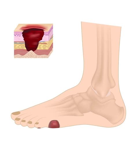 Wound Care Vaporox Treatment For Foot Ulcers Louisville Ky