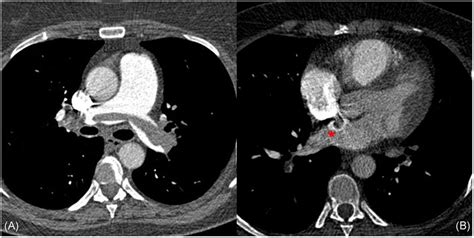 A Preoperative Transverse Contrast‐enhanced Chest Computed Tomography