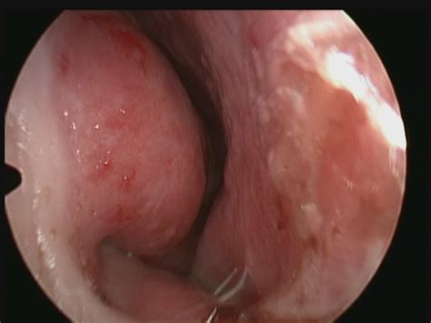 Recurrent Epistaxis In An Adolescent The Bmj