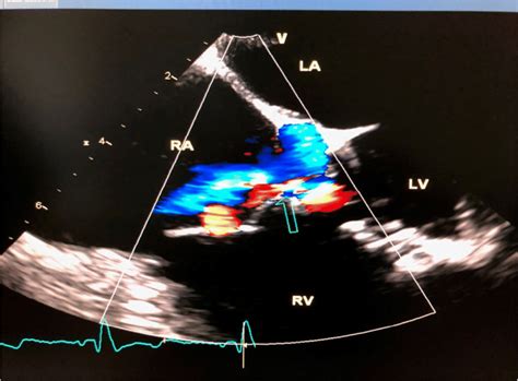 Transesophageal Image Demonstrating A Direct Type I Gerbode Defect