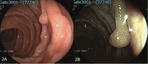A Polyp In The Transverse Colon Pit Pattern Iii A Conventional Download Scientific Diagram