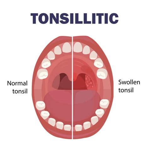 Best Tonsillitis Illustrations Royalty Free Vector Graphics And Clip Art Istock