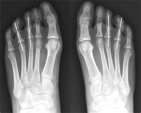 Imaging Considerations In Differentiating Plantar Plate Pathology And