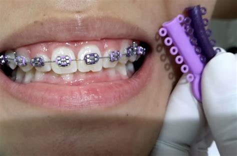 Pin By Sara Kassab Fiorill On Braces Colors In 2024 Braces Colors