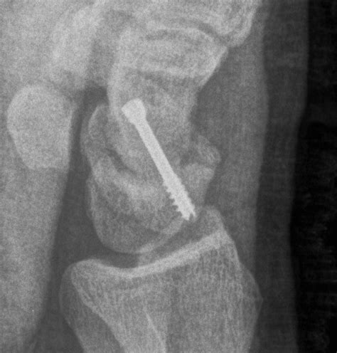 Fracture The Bone School