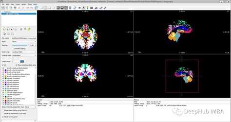人工智能 医学图像的深度学习的完整代码示例使用Pytorch对MRI脑扫描的图像进行分割 deephub SegmentFault 思否