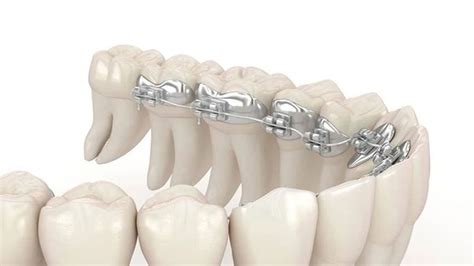 Lingual Braces For Deep Overbite At Salvador Simpson Blog