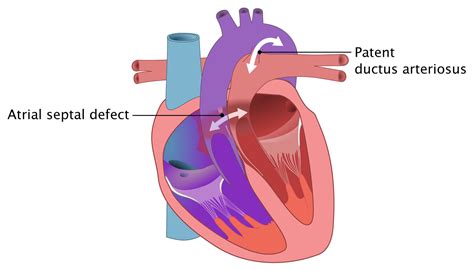Patent Ductus Arteriosus Animation