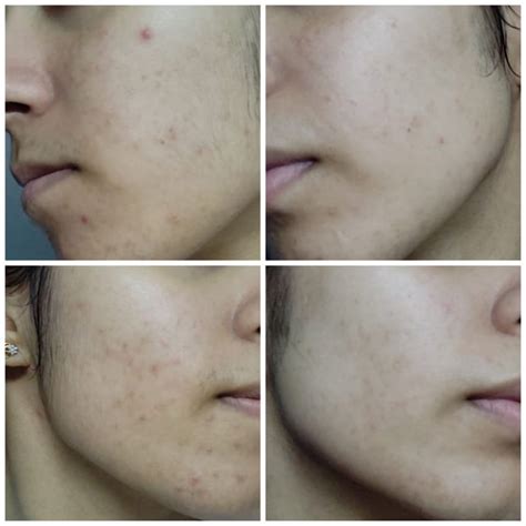 Review Minimalist 2 Alpha Arbutin Serum Used For 15 Months R