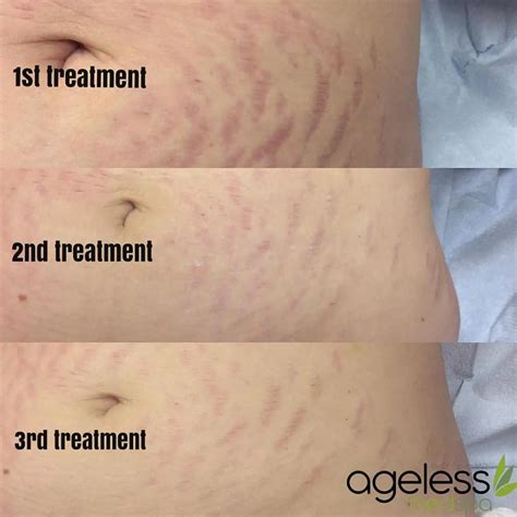Co2 Fractional Laser Treatment Parameters For Stretch Marks