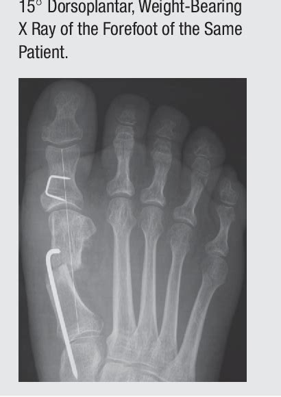 Figure 19 From Modified Minimal Incision Subcapital Osteotomy For Hallux Valgus Correction