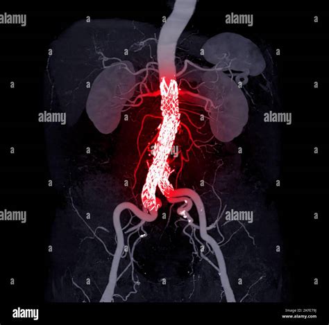 Cta Whole Aorta With Abdominal Aorta Stent Graft Compare 3d Rendering Image In Case Abdominal