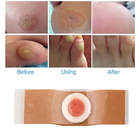 Aomeily Medicated Corn Removal Pads 12 Pcs Set Salicylic Acid