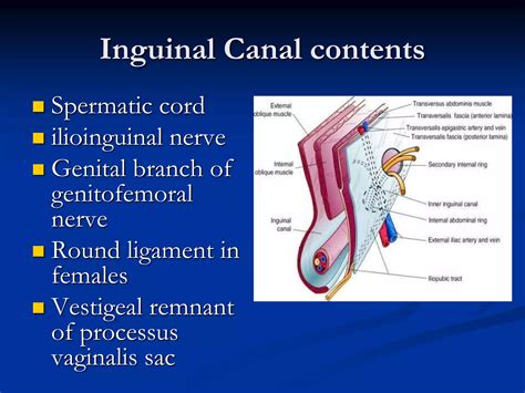 Basics Of Inguinal Hernias Ppt