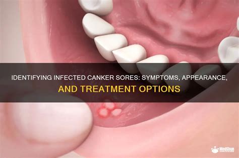 Identifying Infected Canker Sores Symptoms Appearance And Treatment