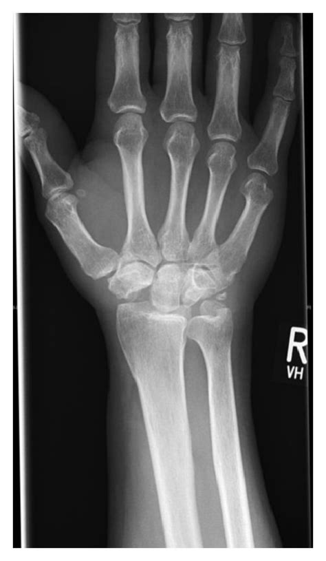 X Ray Postproximal Row Carpectomy Download Scientific Diagram