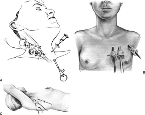 Thyroid Lobectomy Basicmedical Key