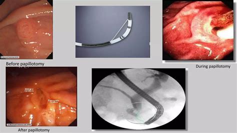 Procedure Of Ercp And T Tube Cholangiography Pptx