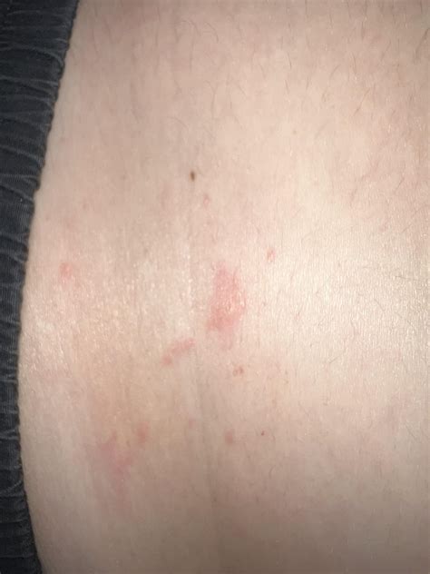 Rash Identification Rmedical