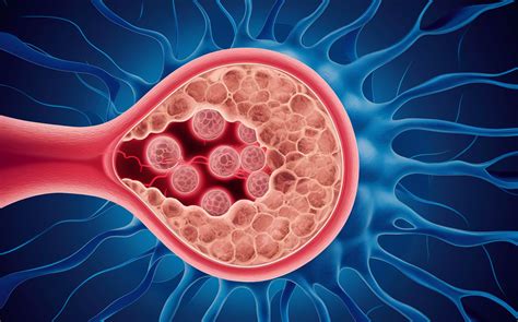 “understanding Ductal Carcinoma In Situ Dcis Causes Symptoms And
