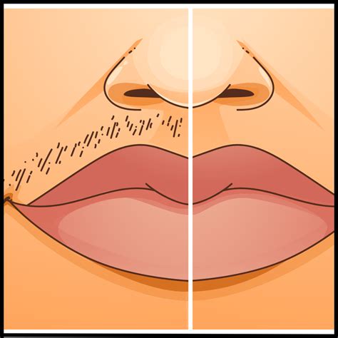 Hirsutism Causes Risk Factors Symptoms Treatment