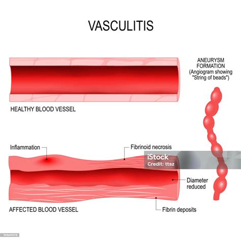 Vaskulitis Adalah Damange Pembuluh Darah Oleh Peradangan Ilustrasi Stok