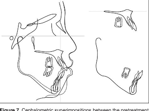 Figure 7 From Treatment Of Vertical Maxillary Excess Without Open Bite In A Skeletal Class Ii