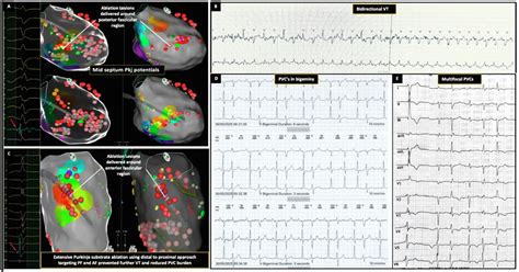 Po 05 016 Multifocal Ectopic Purkinje Related Premature Ventricular