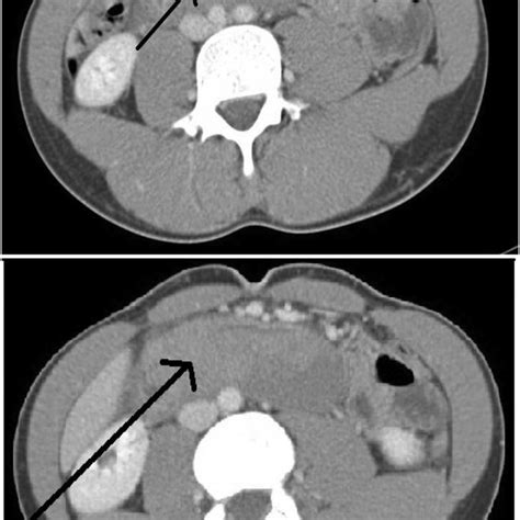Contrast Enhanced Ct Axial View Images Showing Duodenal Hematoma Download Scientific Diagram