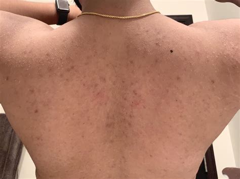 [acne] Help With Back Acne Scars R Skincareaddiction