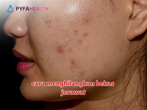 Rahasia Kulit Mulus Temukan Cara Menghilangkan Bekas Jerawat Yang Membandel Blacan