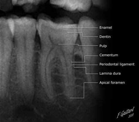 Tooth Anatomy Diagram Radiology Case Radiopaedia Org Dental Anatomy Dental Assistant