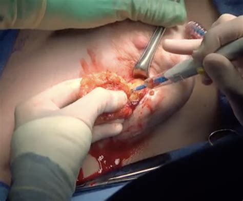 What Happens During A Lumpectomy And Sentinel Node Biopsy