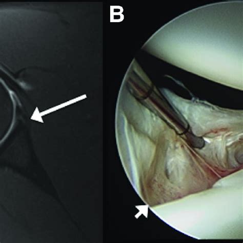 Right Shoulder Magnetic Resonance Arthrogram And Corresponding Download Scientific Diagram