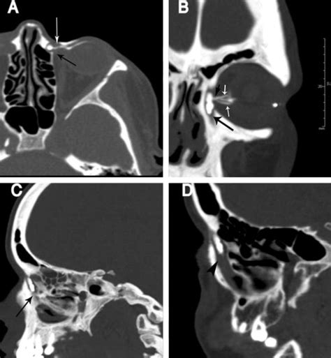 Ctdcg A Axial Image Showed Filling Of The Common Canaliculus White