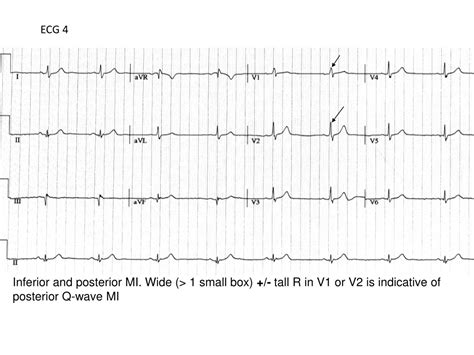 Ppt Ecg Interpretation For Cardiology Cases Powerpoint Presentation