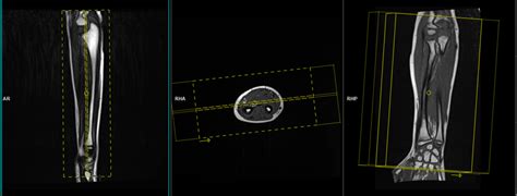 Forearm Mri Protocols And Planning Indications For Mri Forearm Radius And Ulna Scan