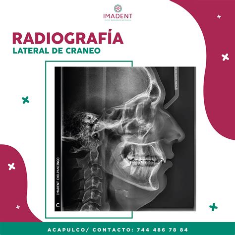 Anatomía De La Radiografía Lateral Del Cráneo