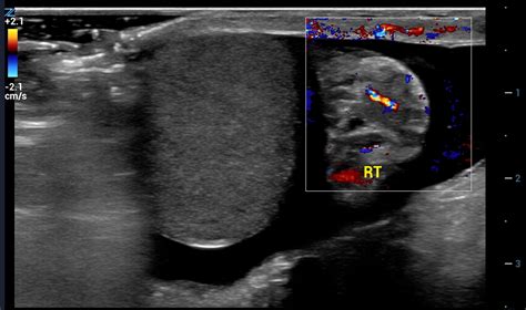 Testicular Torsion Ultrasound